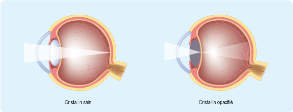 Cataracte - Centre ophtalmologique Lyon - Ophta Part-Dieu